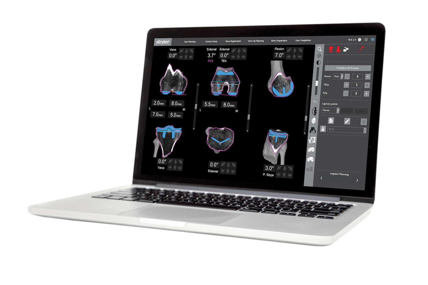 Mako Robotic Knee & Hip Replacement | Smarter, Faster Recovery