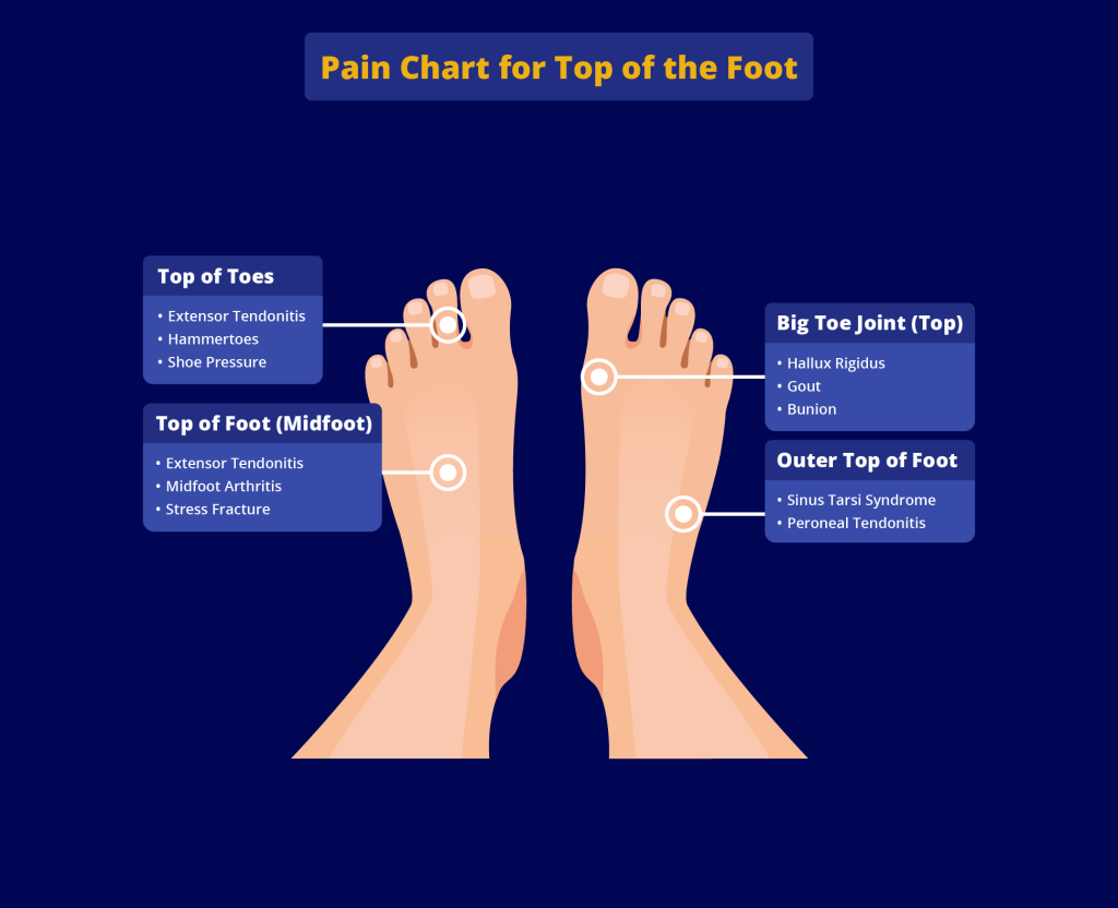 Foot Pain Chart: What Your Pain Location Might Mean